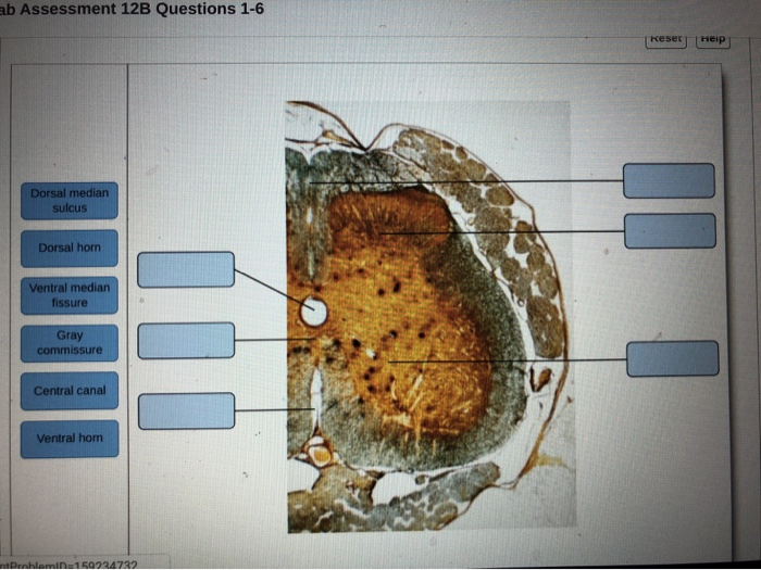 Solved ab Assessment 12B Questions 1-6 Dorsal median sulcus | Chegg.com