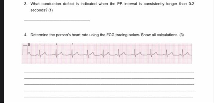 Solved 3. What conduction defect is indicated when the PR | Chegg.com