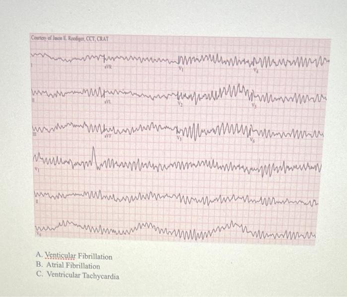 Solved A. Venticular Fibrillation B. Atrial Fibrillation C. | Chegg.com