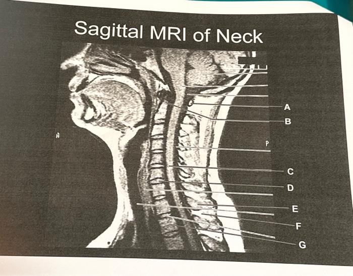 Solved Sagittal MRI of Neck | Chegg.com