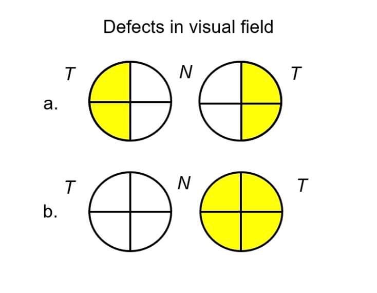 Solved Given the following defect in the visual field, | Chegg.com