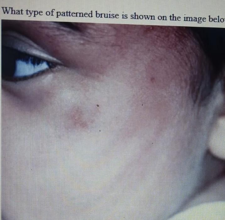 Solved What type of patterned bruise is shown on the image | Chegg.com