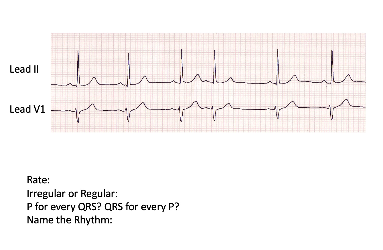 Solved Rate:Irregular or Regular:P for every QRS? ﻿QRS for | Chegg.com