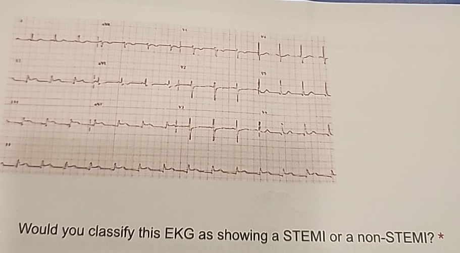 Solved Would you classify this EKG as showing a STEMI or a | Chegg.com