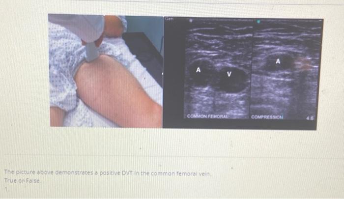 Solved A V COMMON FEMORAL COMPRESSION The picture above | Chegg.com