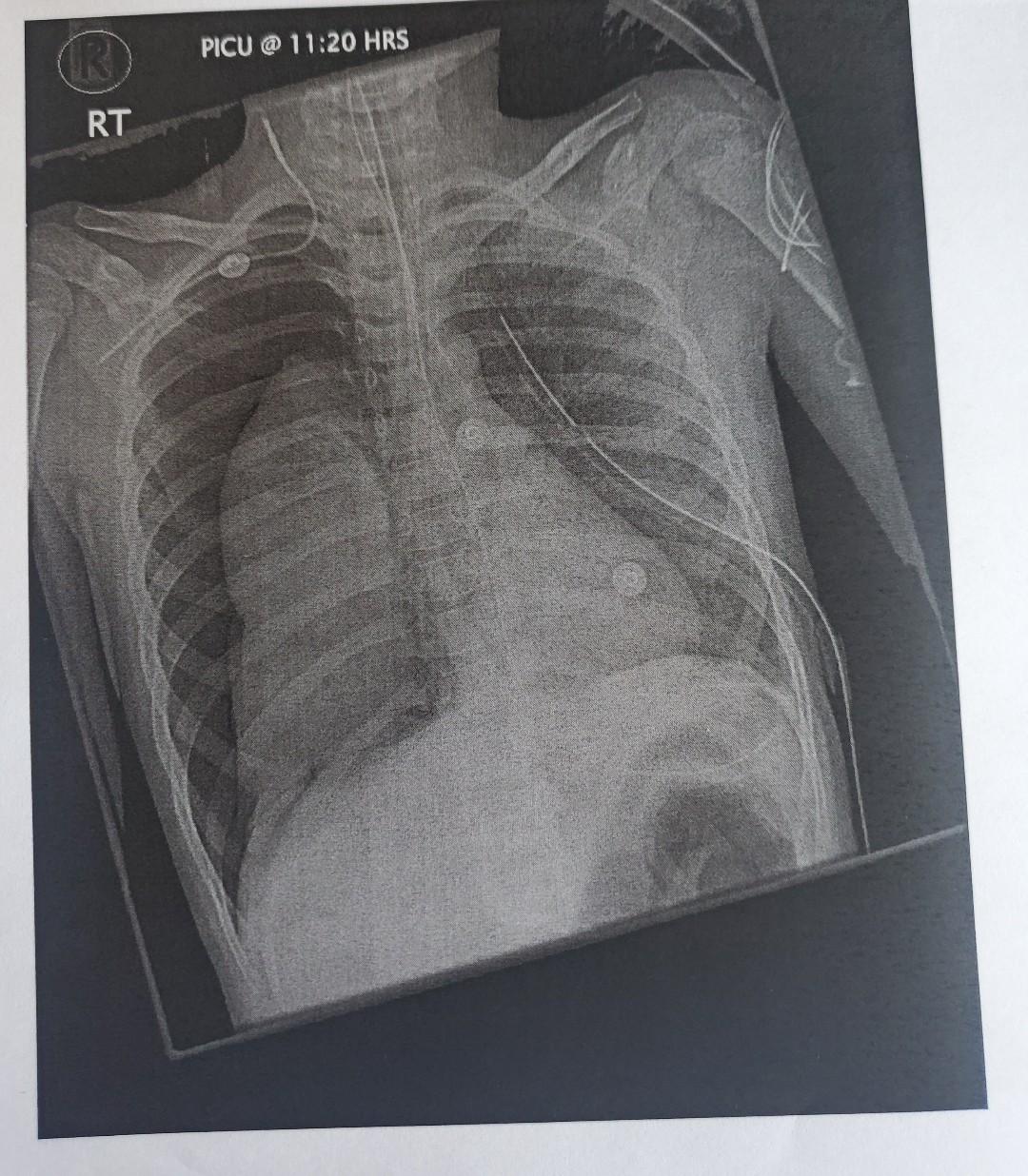 13- ﻿interpret this CXR and explain reasoning behind | Chegg.com