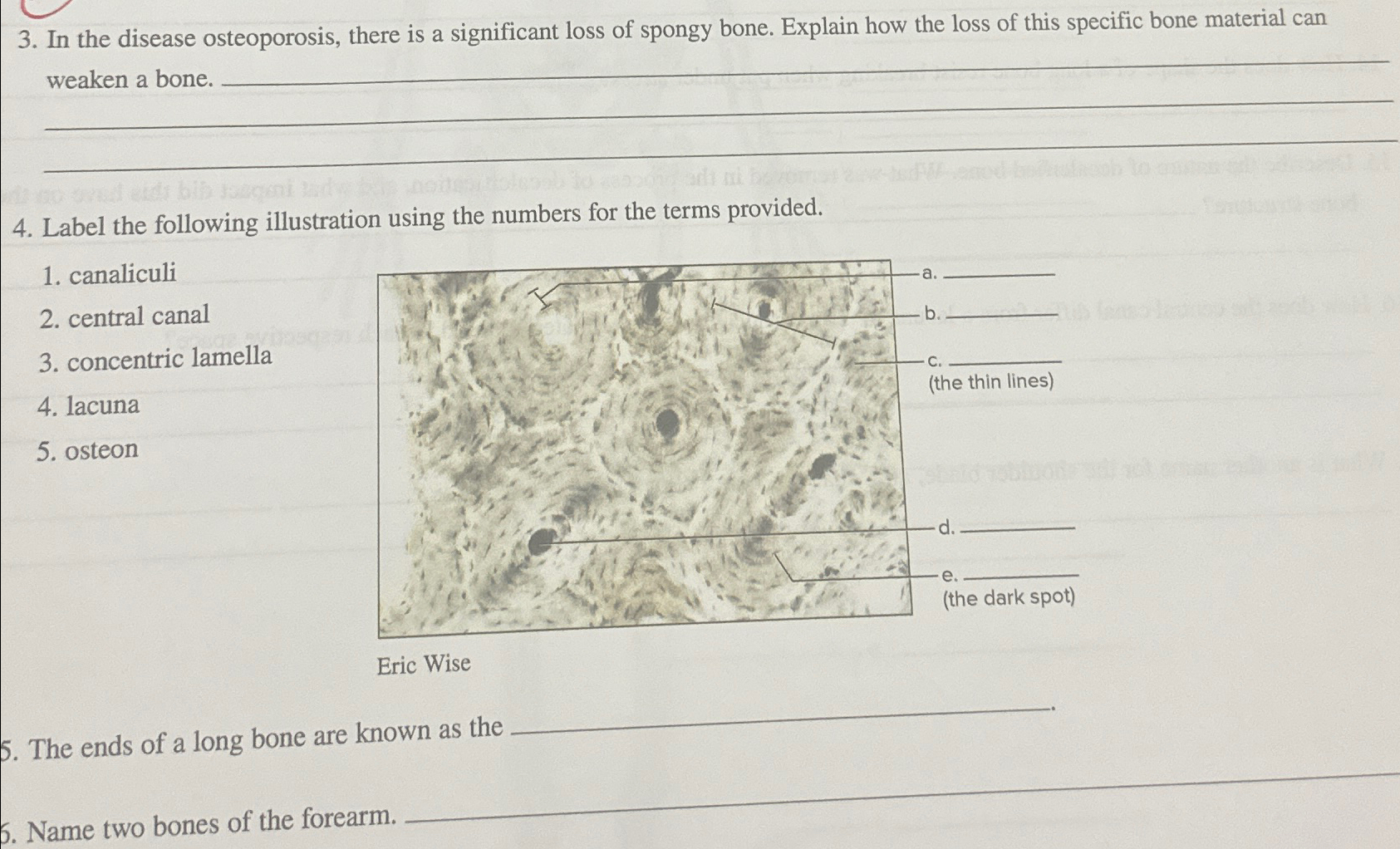 In the disease osteoporosis, there is a significant | Chegg.com
