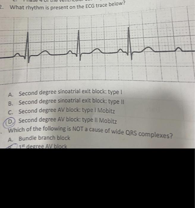 Solved What rhythm is present on the ECG trace below? A. | Chegg.com