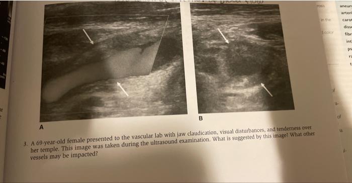 Solved A 3. A 69-year-old female presented to the vascular | Chegg.com
