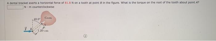Solved A dental bracket exerts a horizontal force of 81.8 N | Chegg.com