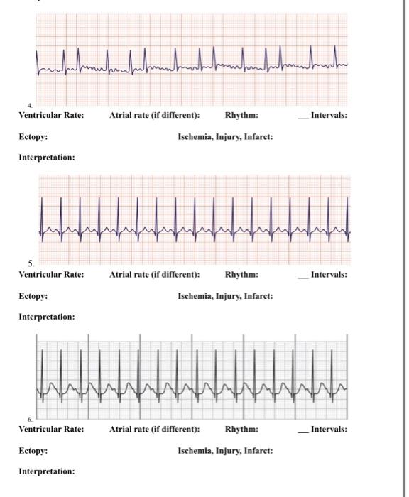 Solved 4. bunduk Ventricular Rate: Ectopy: Interpretation: | Chegg.com