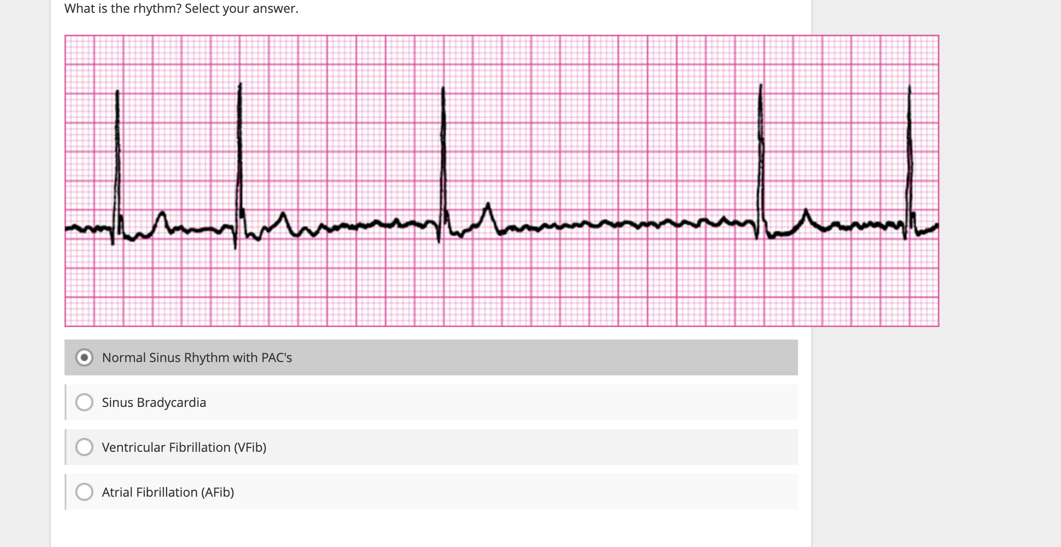 Solved What is the rhythm? ﻿Select your answer.Normal Sinus | Chegg.com