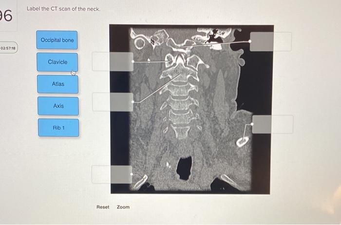 Solved Label the CT scan of the neck 26 Occipital bone | Chegg.com