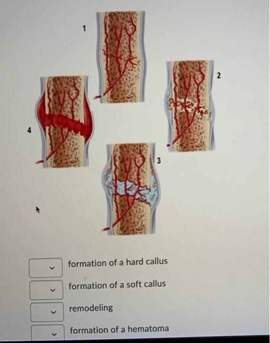 Solved 1 2 3 formation of a hard callus
