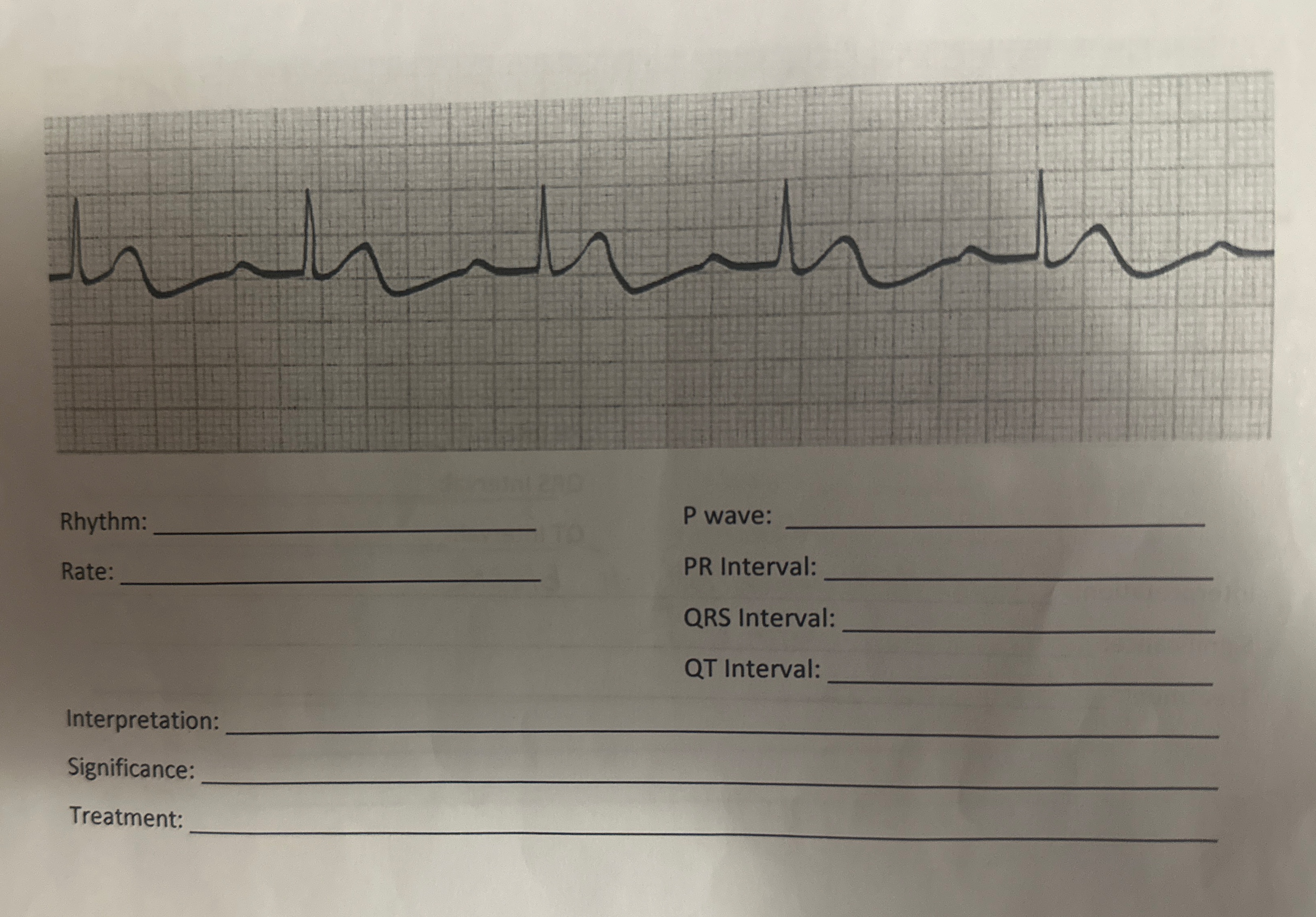Solved Rhythm: Rate: P wave: PR Interval: QRS Interval: | Chegg.com