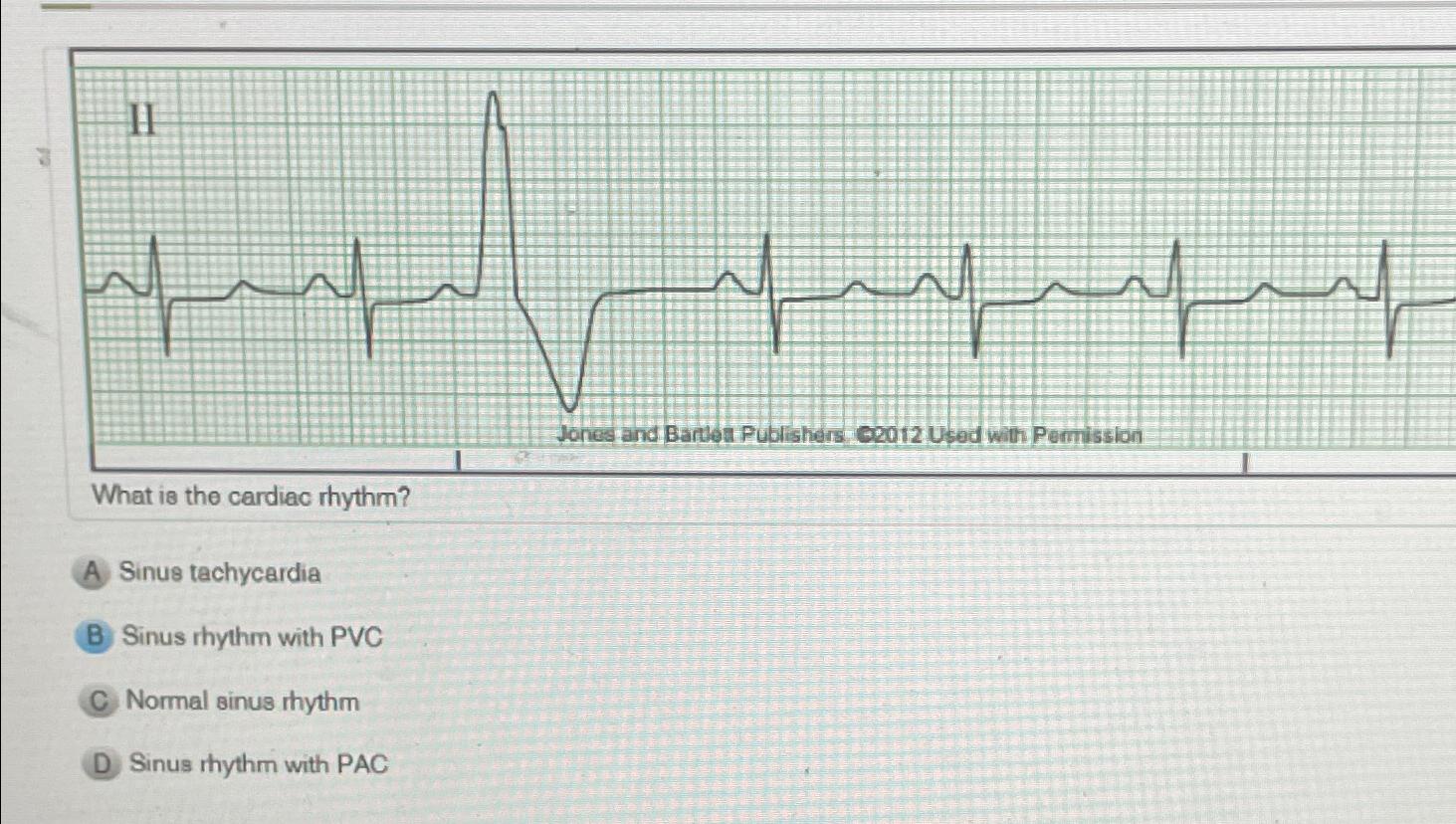 Solved What is the cardiac rhythm?Sinus tachycardiaSinus | Chegg.com