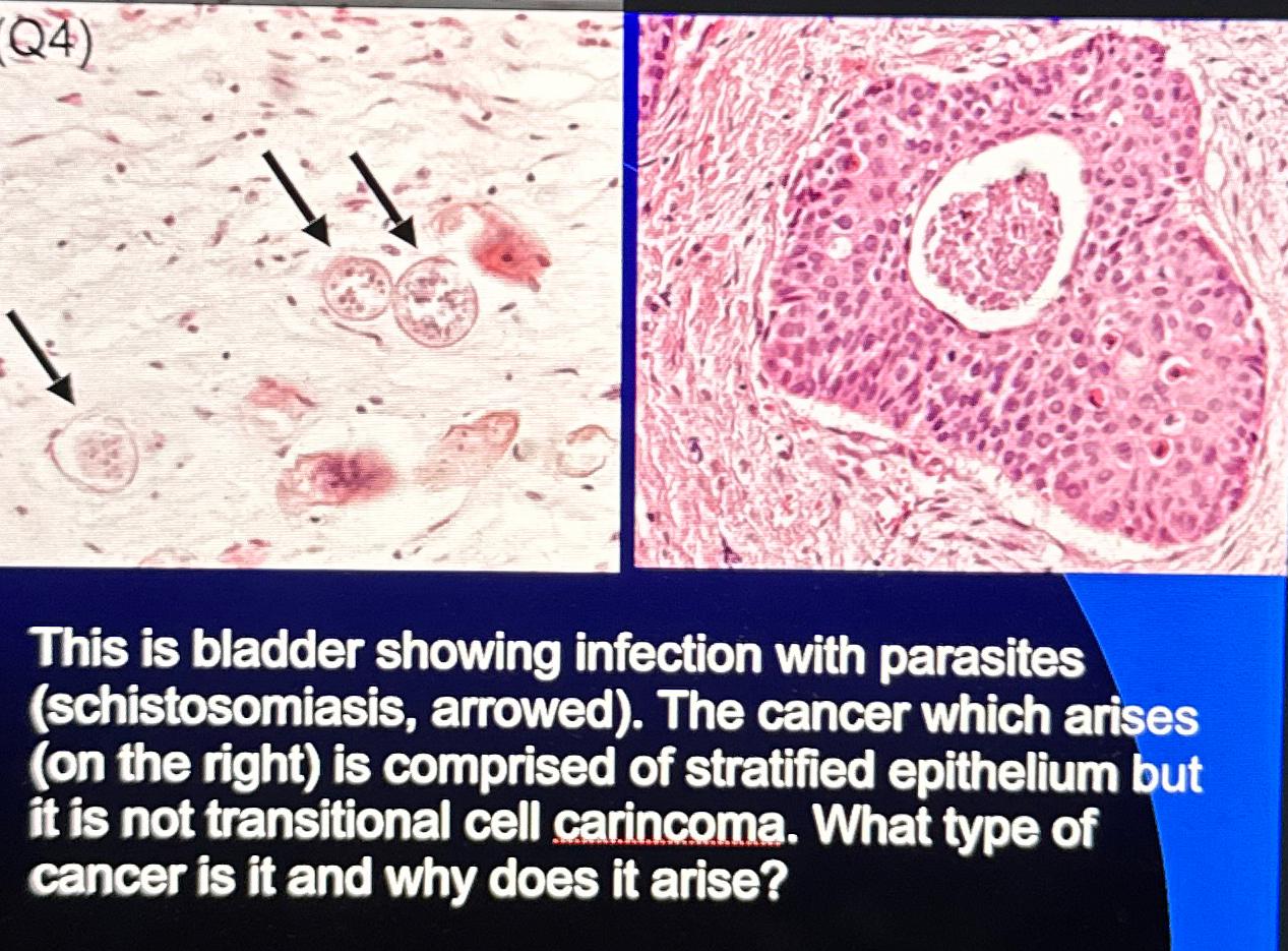 Solved This is bladder showing infection with parasites | Chegg.com