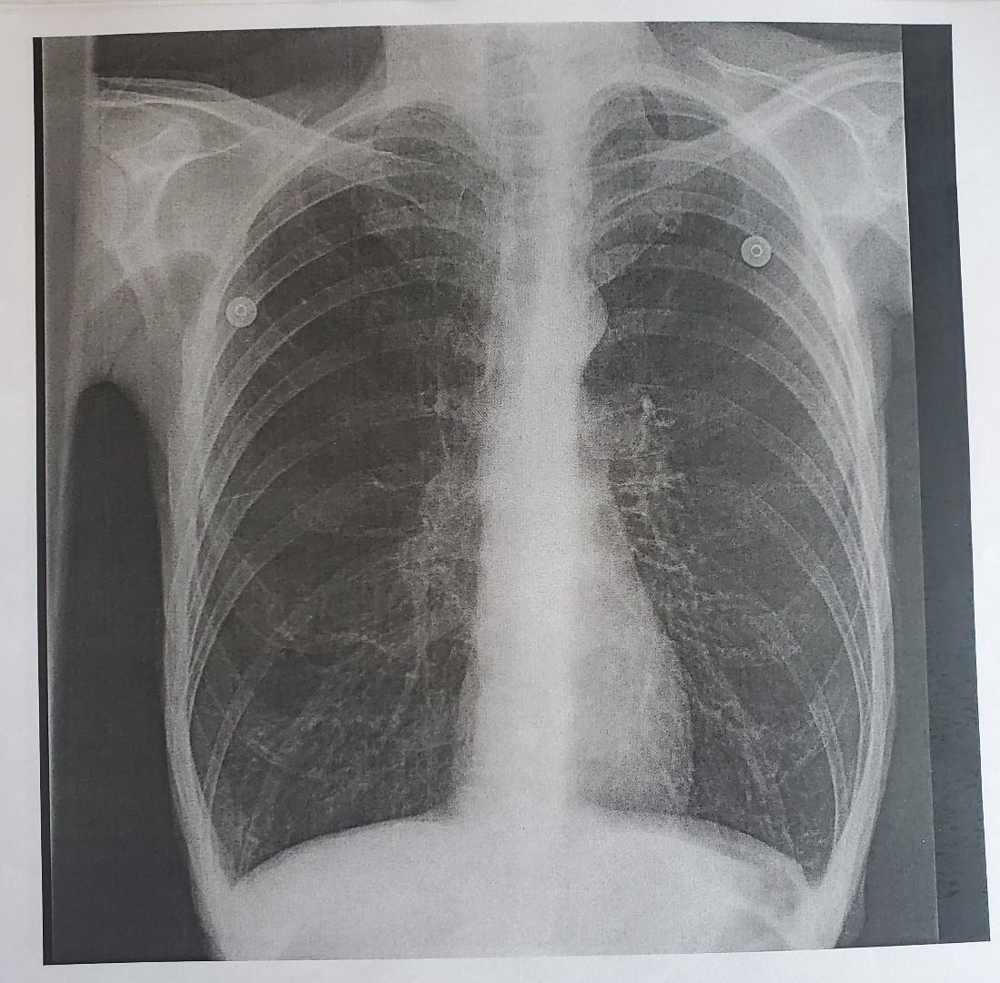 Solved 8- ﻿interpret this CXR and explain reasoning behind | Chegg.com
