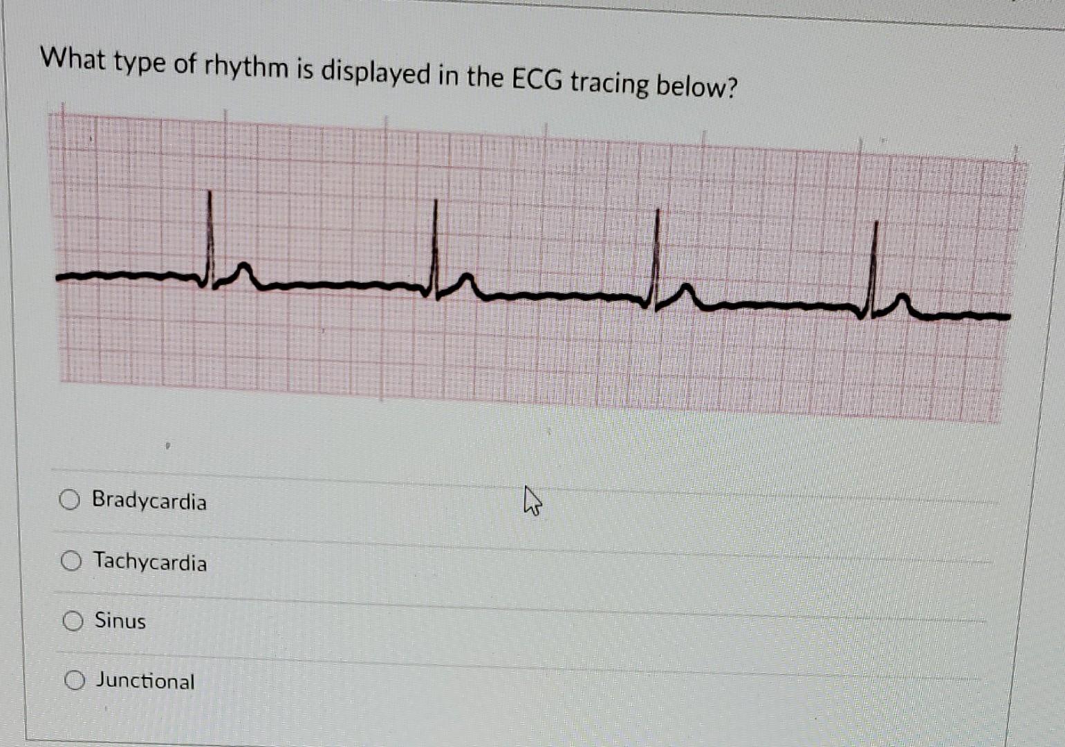 Solved What type of rhythm is displayed in the ECG tracing | Chegg.com