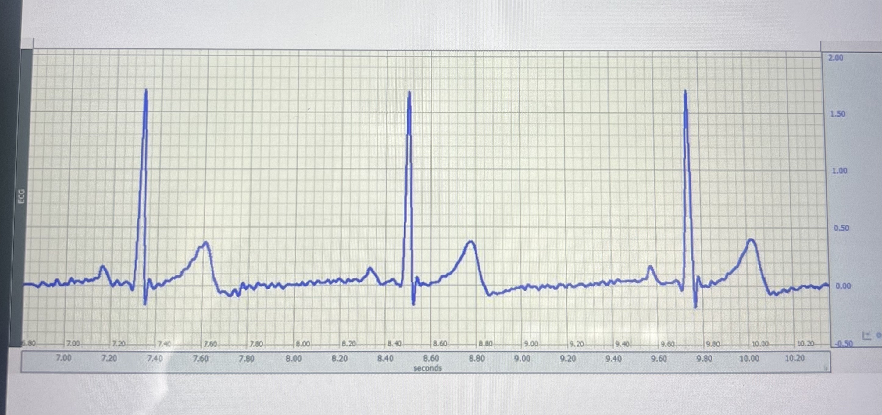 Solved Find the amplitude + ﻿duration of the:P Wave,PT | Chegg.com