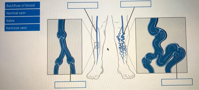 Solved Backflow of blood Normal vein Valve Varicose vein | Chegg.com