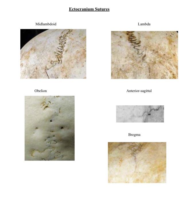 Ectocranium Sutures Midlambdoid Lambda Obelion | Chegg.com