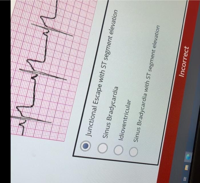 Sinus Arrhythmia Sinus Rhythm with PVC Sinus Rhythm | Chegg.com