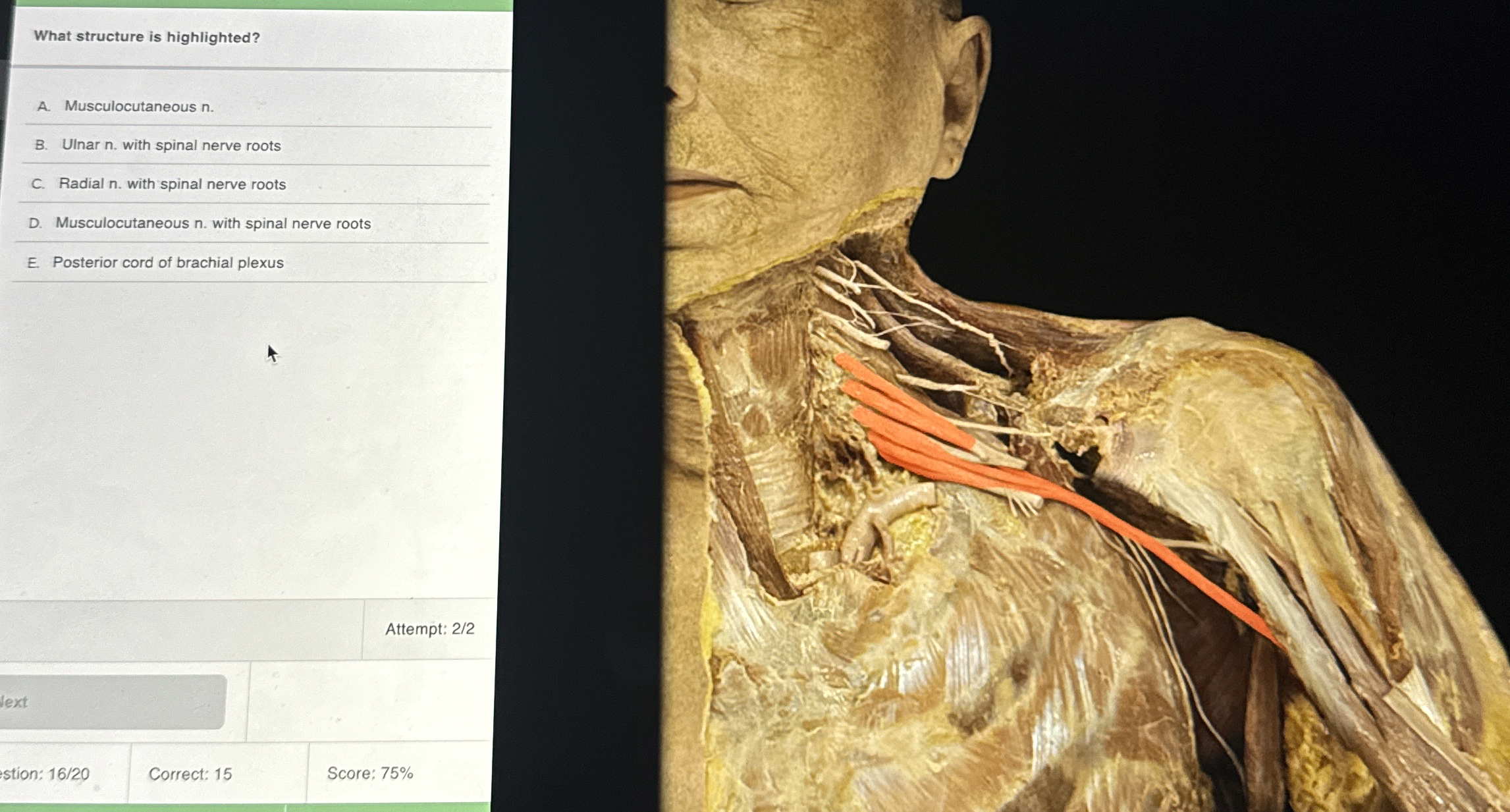 Solved What structure is highlighted?A. ﻿Musculocutaneous | Chegg.com
