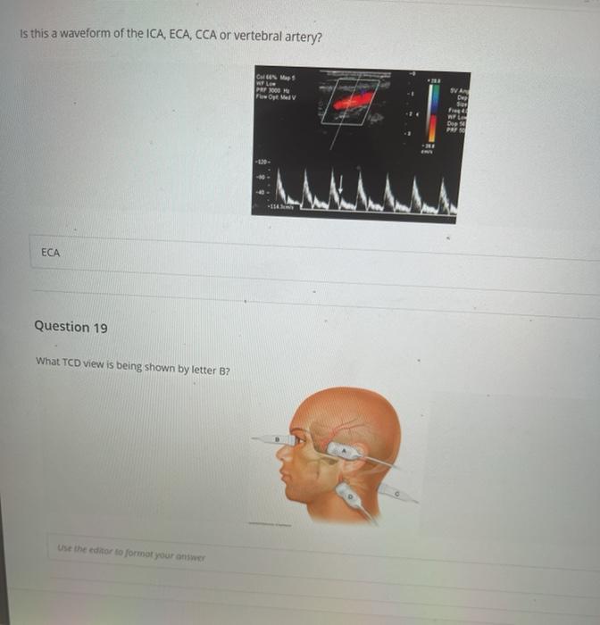 Solved Is this a waveform of the ICA, ECA, CCA or vertebral | Chegg.com