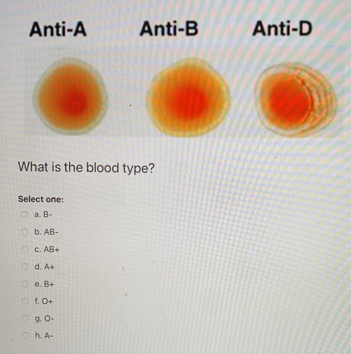 Solved Anti-A Anti-B Anti-D What is the blood type? Select | Chegg.com