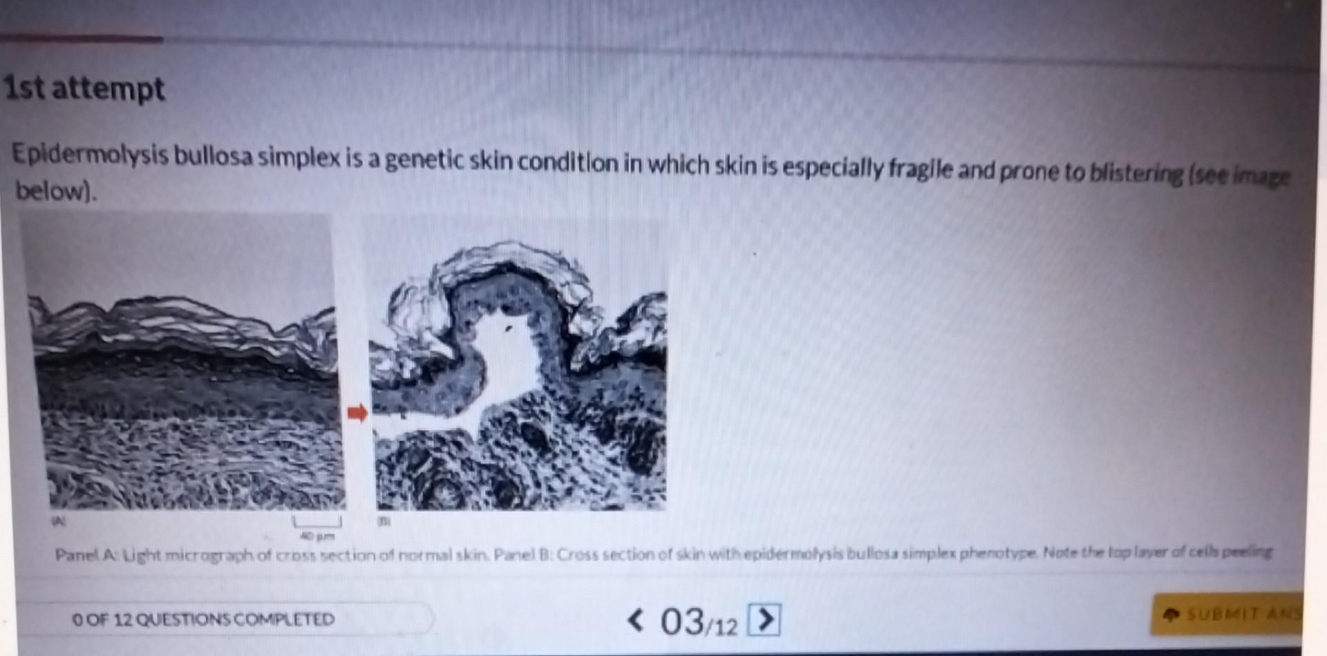 Solved Epidermolysis bullosa simplex is a genetic skin | Chegg.com