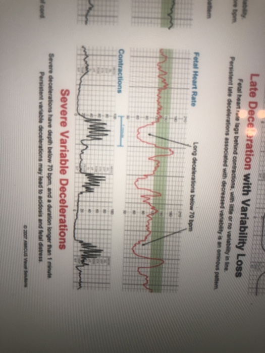Solved Fetal Monitor Patterns Near Cocos Reassuring Pattern | Chegg.com
