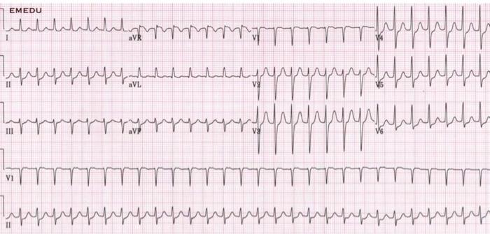 Solved FOR aVR | Chegg.com