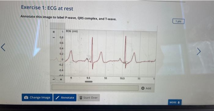 Solved Annotate this image to label P-wave, QRS complex, and | Chegg.com