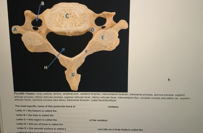 Solved B C! A E H Possible Names: body, pedicle, lamina, | Chegg.com