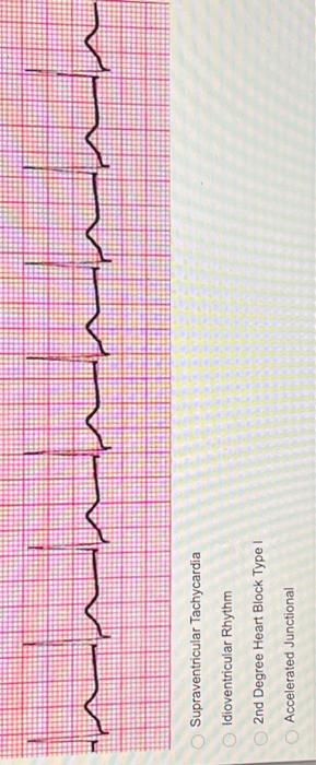 Solved Junctional Tachycardia Sinus Tachycardia 2nd Degree | Chegg.com