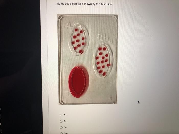 Solved Name the blood type shown by this test slide o A+ A- | Chegg.com