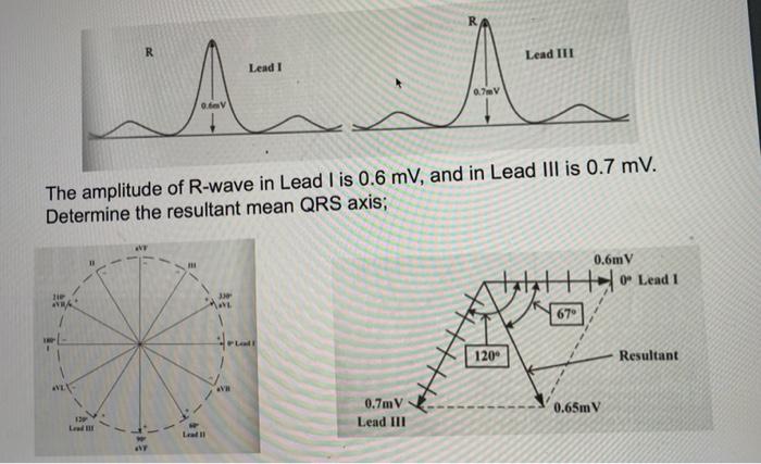 Solved Lead III Lead I 0.7V The amplitude of R-wave in Lead | Chegg.com