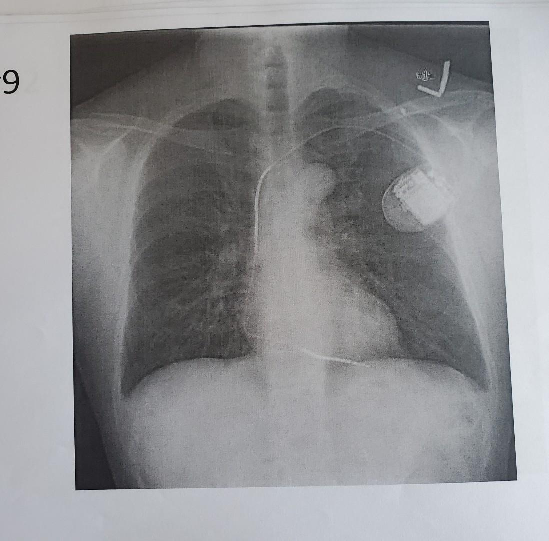 Solved 9- ﻿interpret this CXR and explain reasoning behind | Chegg.com