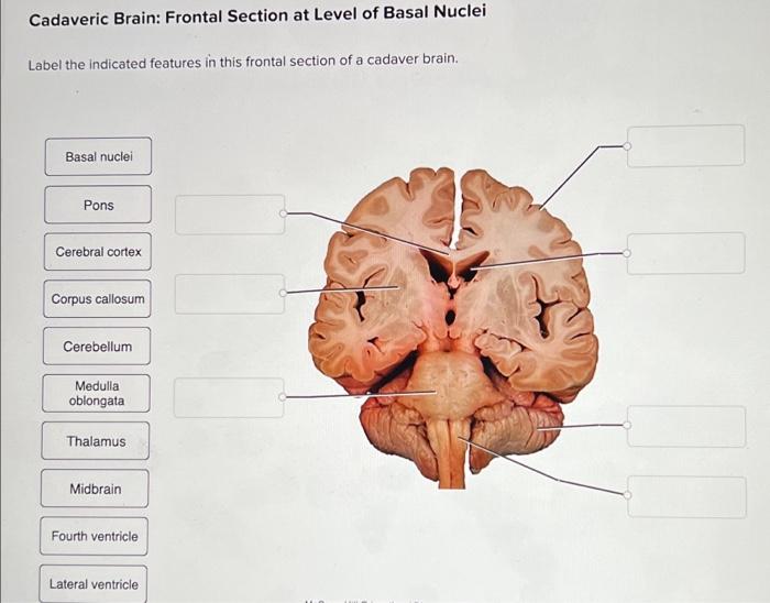 Solved Parts of Brainstem: Posterior View Label the | Chegg.com