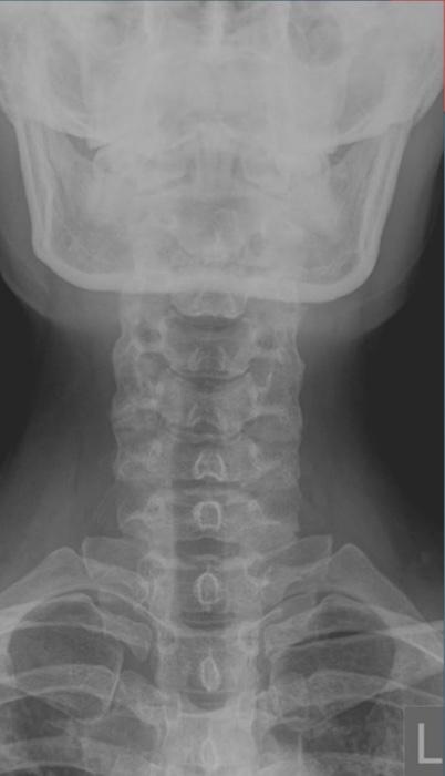 Solved Any pathologies, disease, ADI space, Posterior arch, | Chegg.com