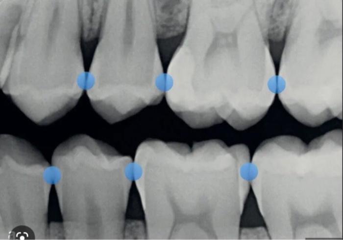 Solved what are the cotact area of each teeth ?where do each | Chegg.com