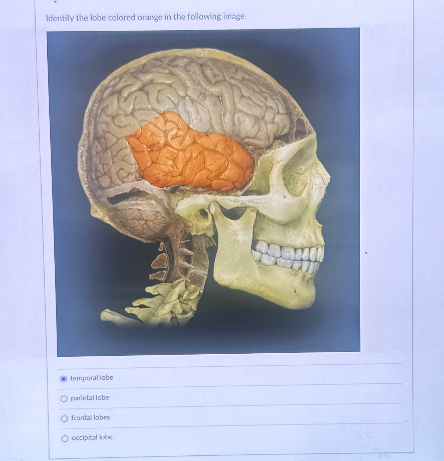 Solved Identify the lobe colored orange in the following | Chegg.com
