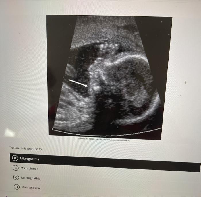 Solved The arrow is pointed to Micrognathia B Microglossia | Chegg.com