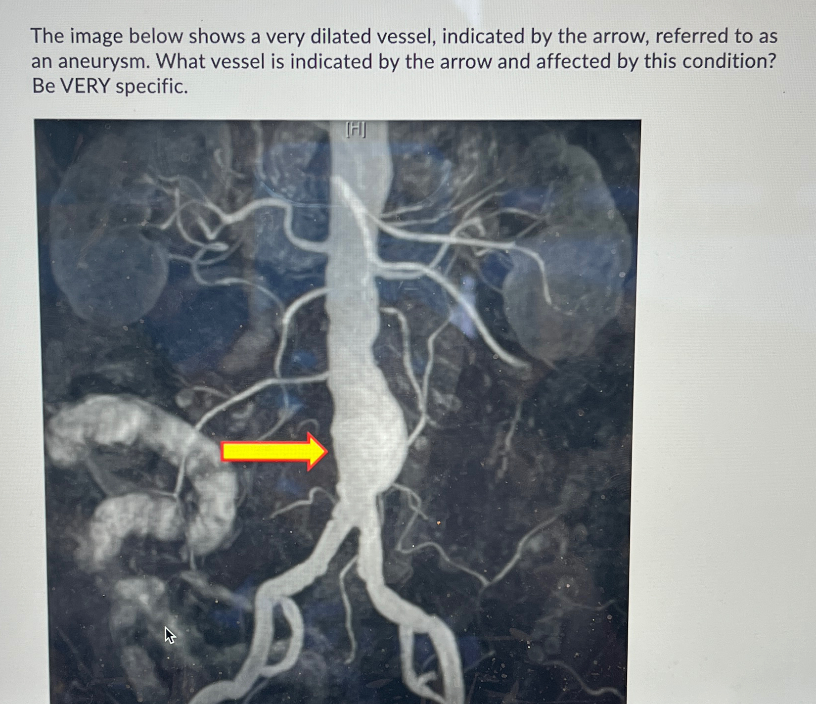 Solved The image below shows a very dilated vessel, | Chegg.com