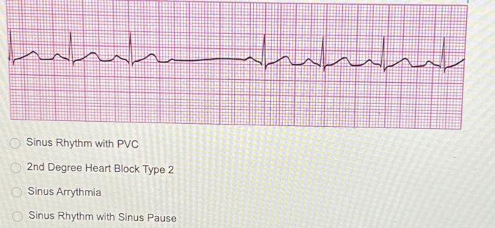 Solved Call the Monitor Tech for confirmation of rhythm Call | Chegg.com