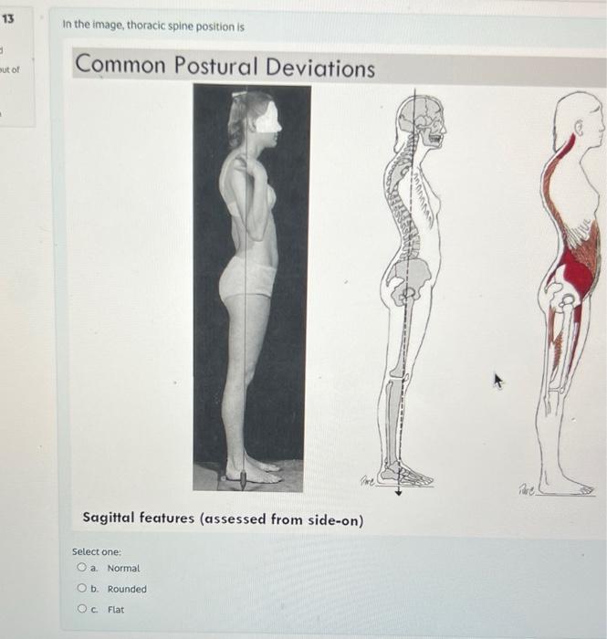 Solved Common Postural Deviations Sagittal features | Chegg.com