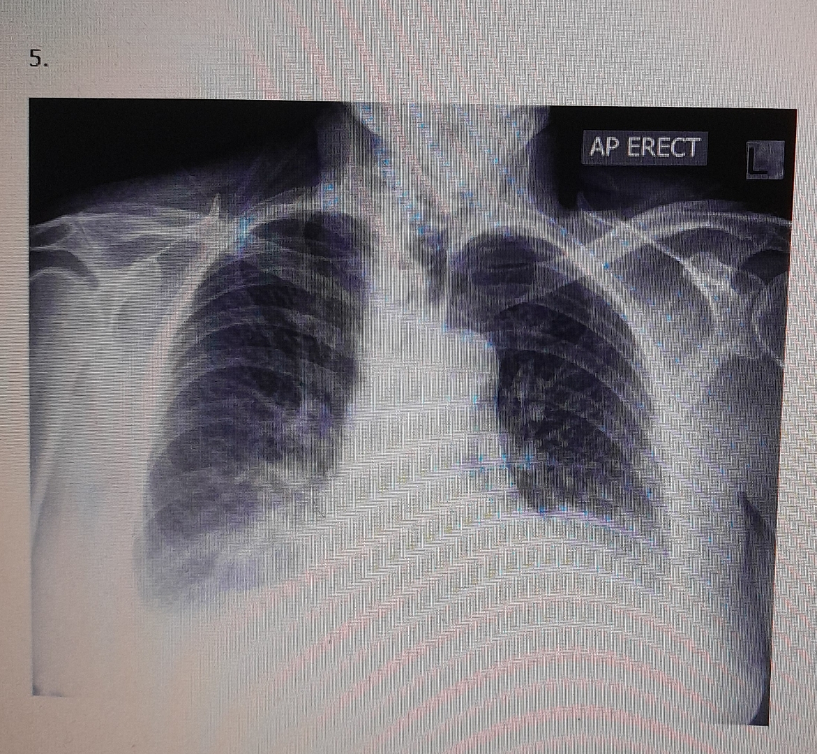 Solved identify each chest x-ray as normal or abnormal if | Chegg.com