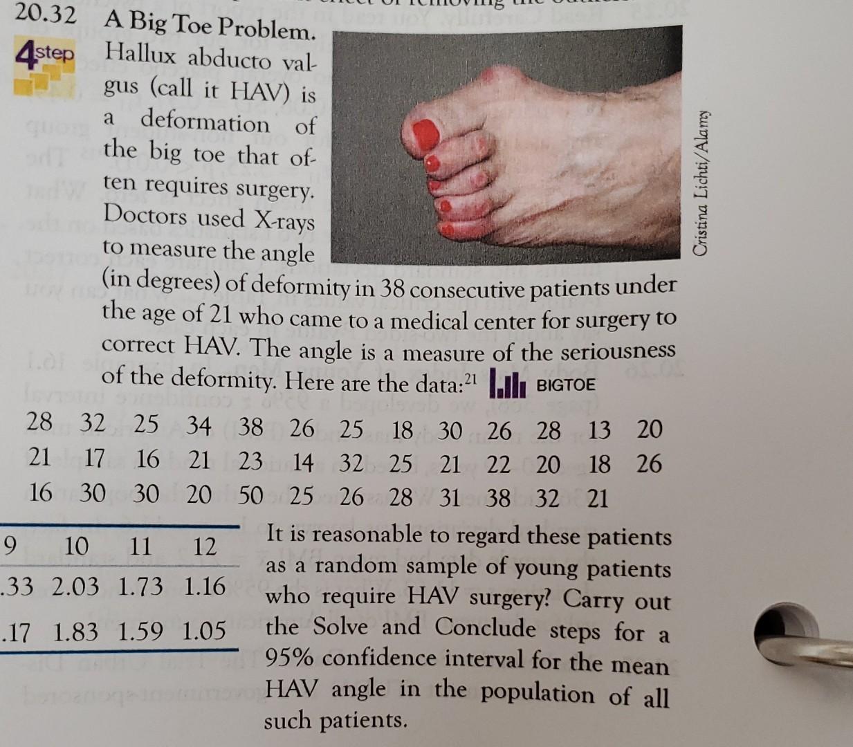 Solved A Big Toe Problem. Hallux abducto valgus (call it | Chegg.com