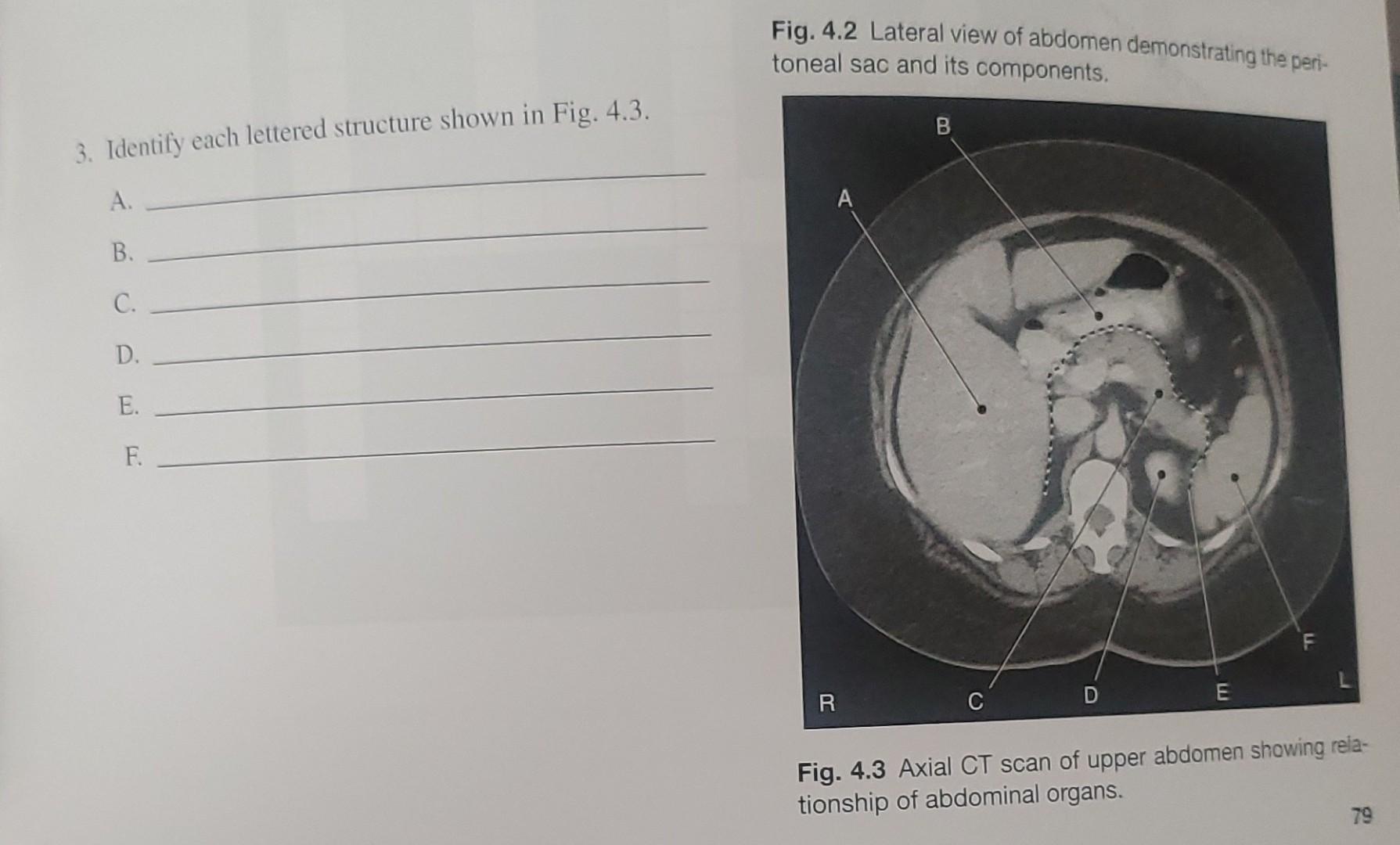 Fig. 4.2 Lateral view of abdomen demonstrating the | Chegg.com